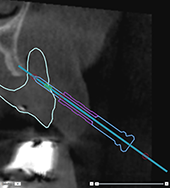 Correct Inclination and Depth of Anchor Pins